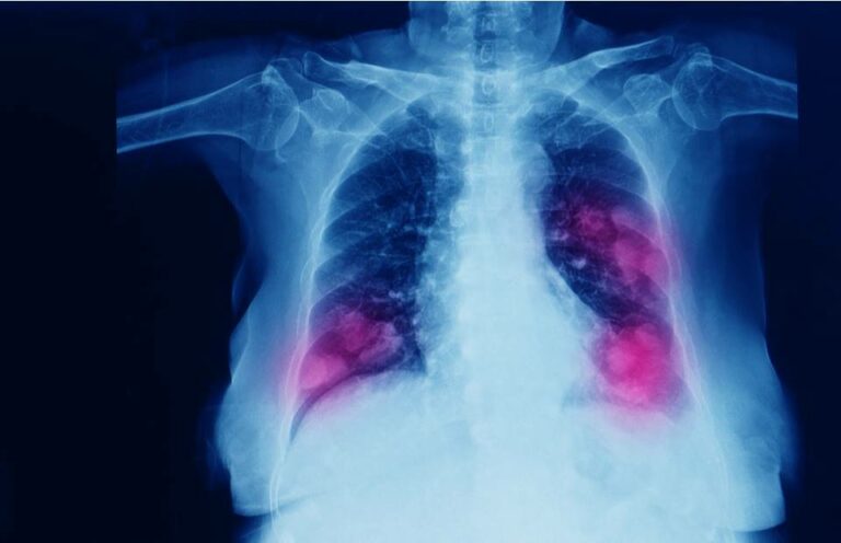 Zrádná rakovina plic postihuje i nekuřáky. Rozpoznejte první příznaky ...