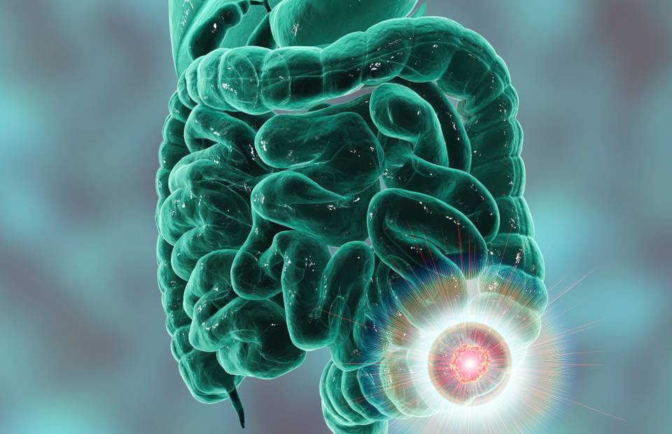 Rakovina ve střevě je v České republice nejčastější. Poznejte její ...